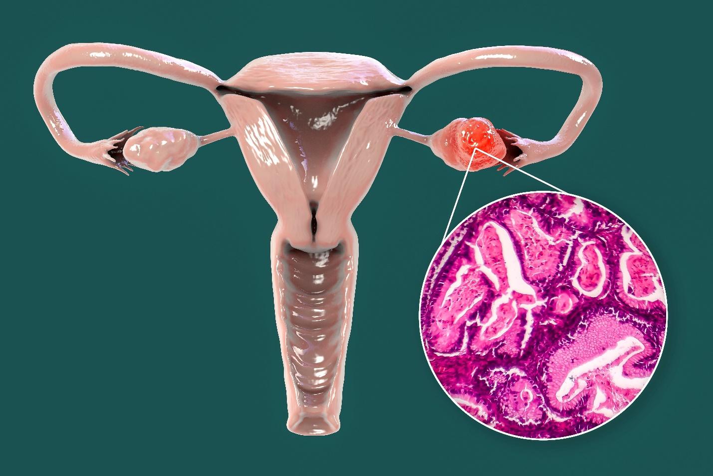 Are Ovarian Cysts Normal? Here Are Some Telltale Signs You Should Get ...